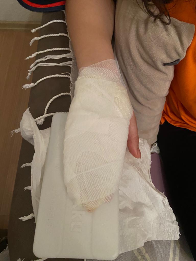 PorsiOn Porsi10 Gurme Cheddarlı Patates Topları'ndan Kaynaklı Yüz Ve El ...