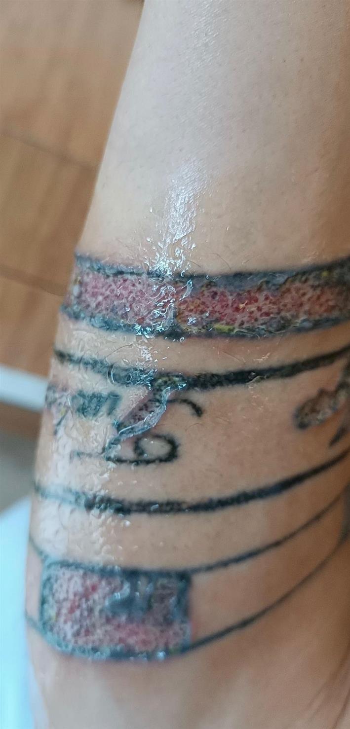 Asya Kavas Beauty Palace Dermapen Paketi Almıştık, Eşimin Kolunda 2 ...