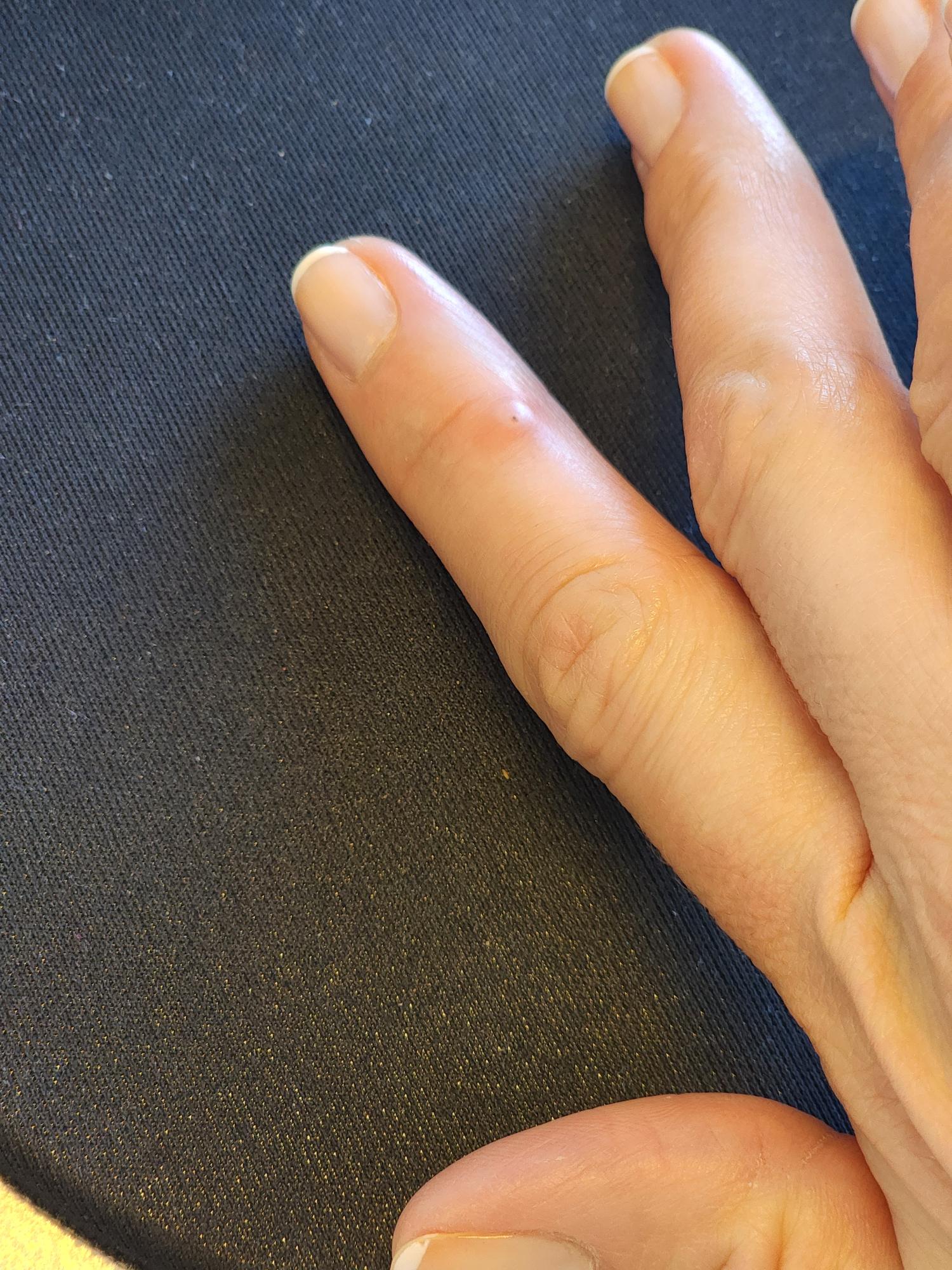 Dyson V15 Süpürge Tetiği Elde Nasır Yapıyor - Şikayetvar