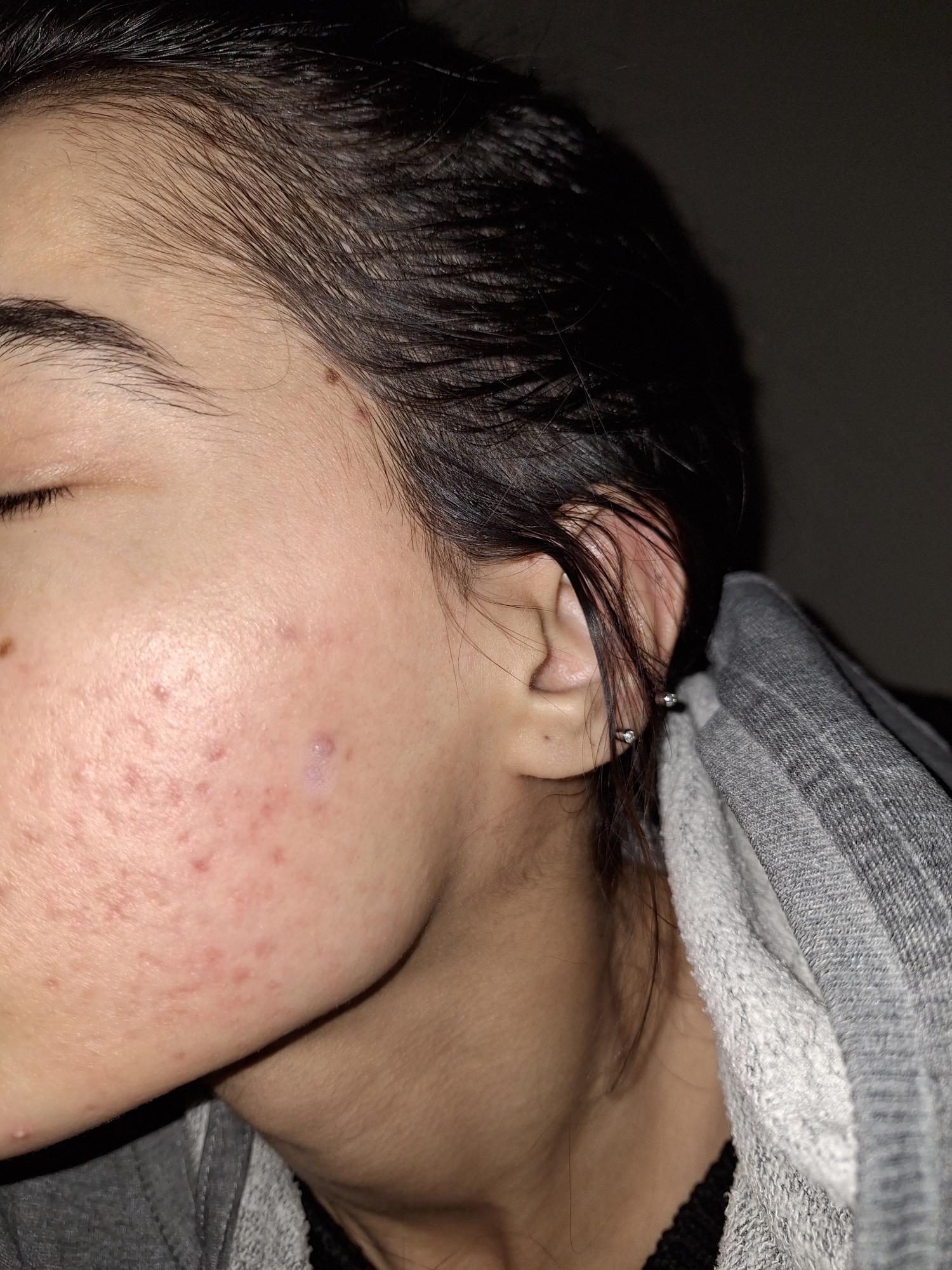 Çözüldü: Recete.com Bioderma Photoderm Aquafluid Akne Ve Komedon ...