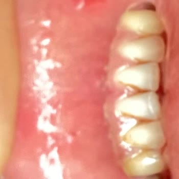 Parodontax Gum Protection Toothpaste Side Effects - Xolvie