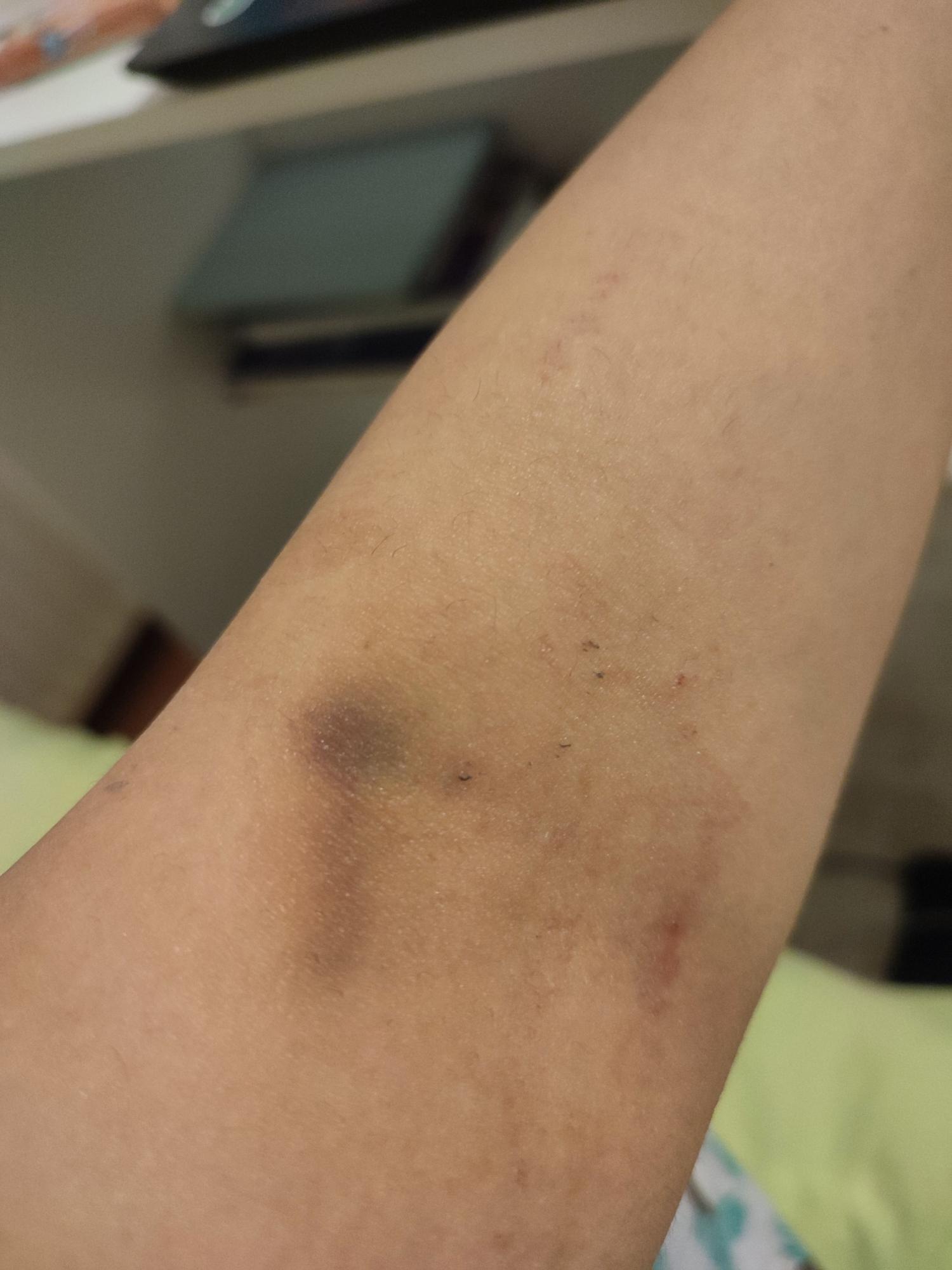 Rumeli Hospital Serumdan Sonra Morarma - Şikayetvar