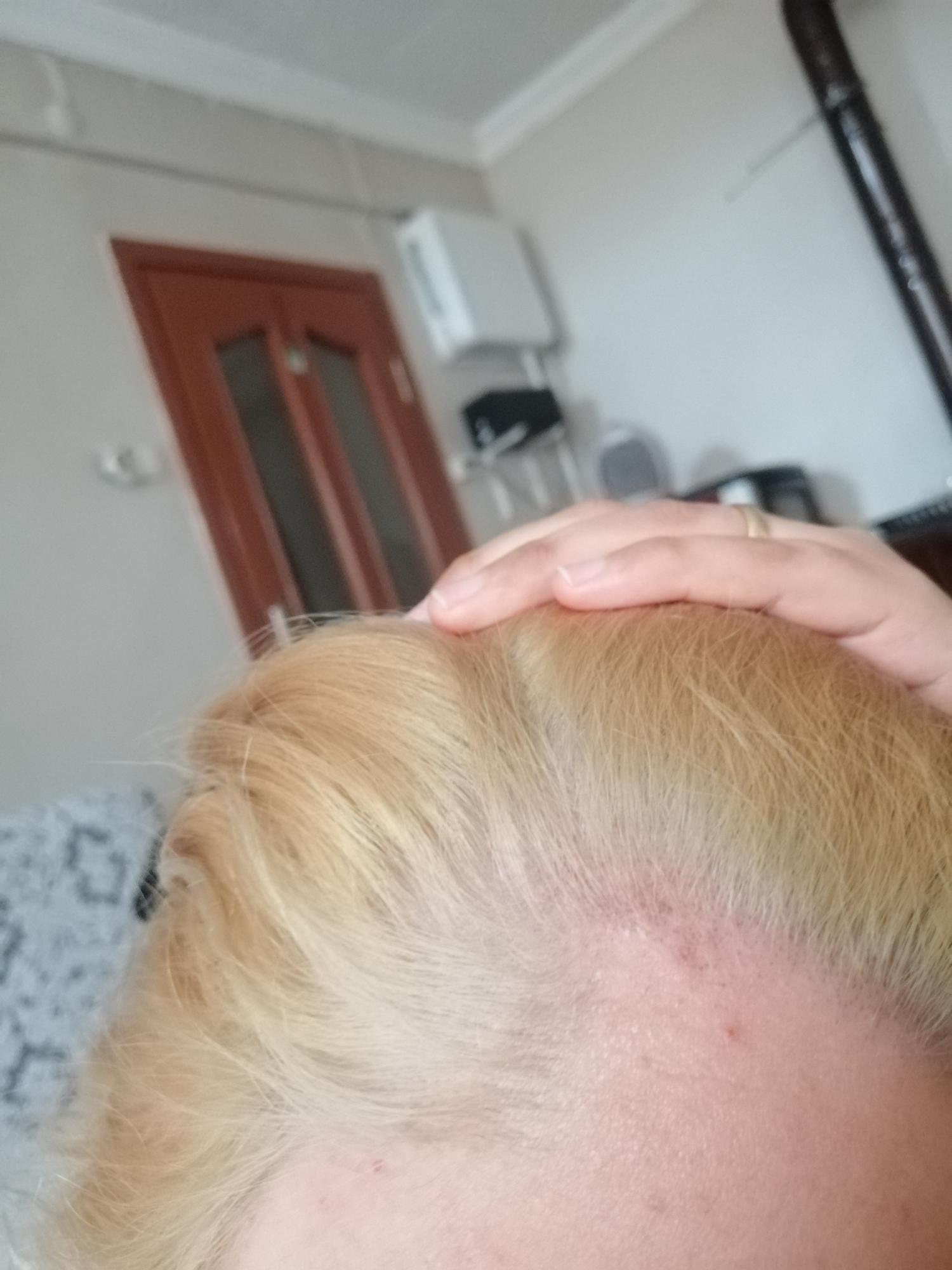 Palette Saç Boyası Saç Derimde Yara Yaptı Derimi Yaktı - Şikayetvar