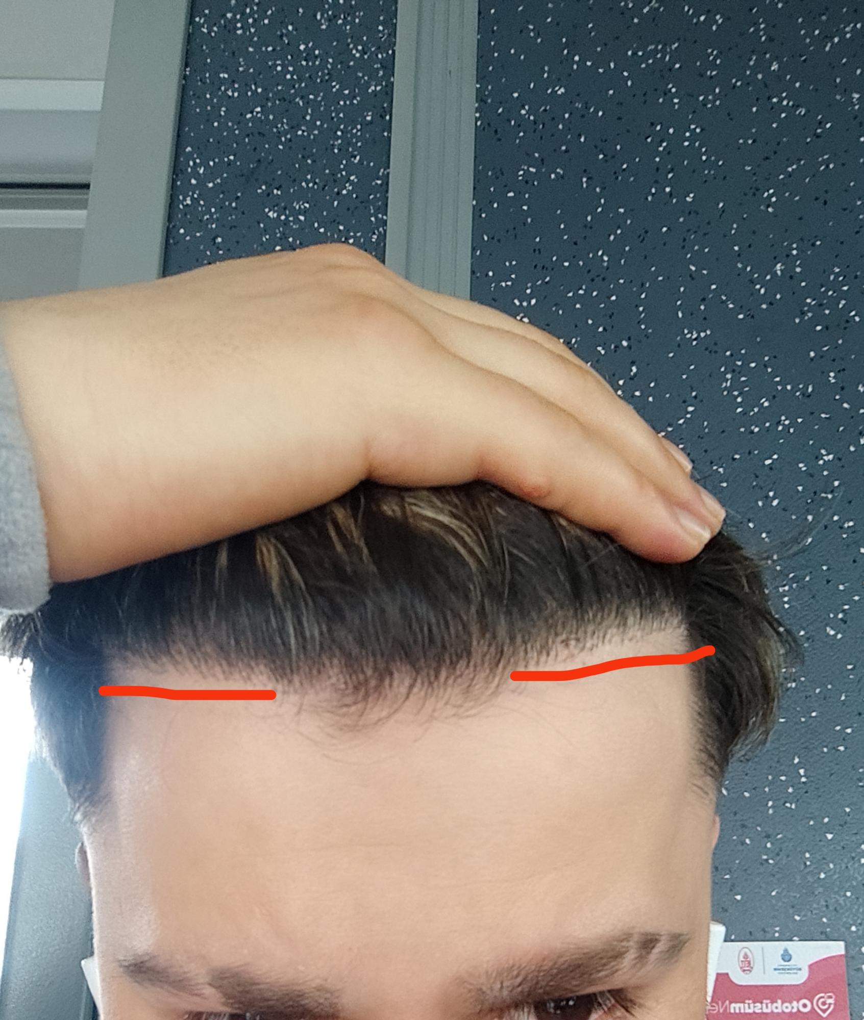 Adem Köse Saç Çizgim Geride - Şikayetvar