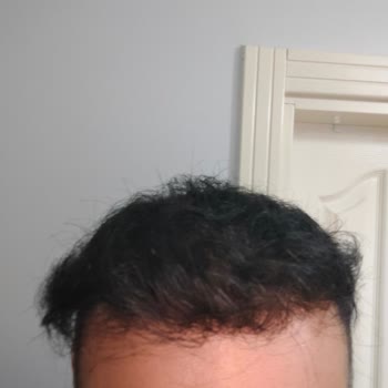 Adem Köse Saç Çizgim Geride - Şikayetvar