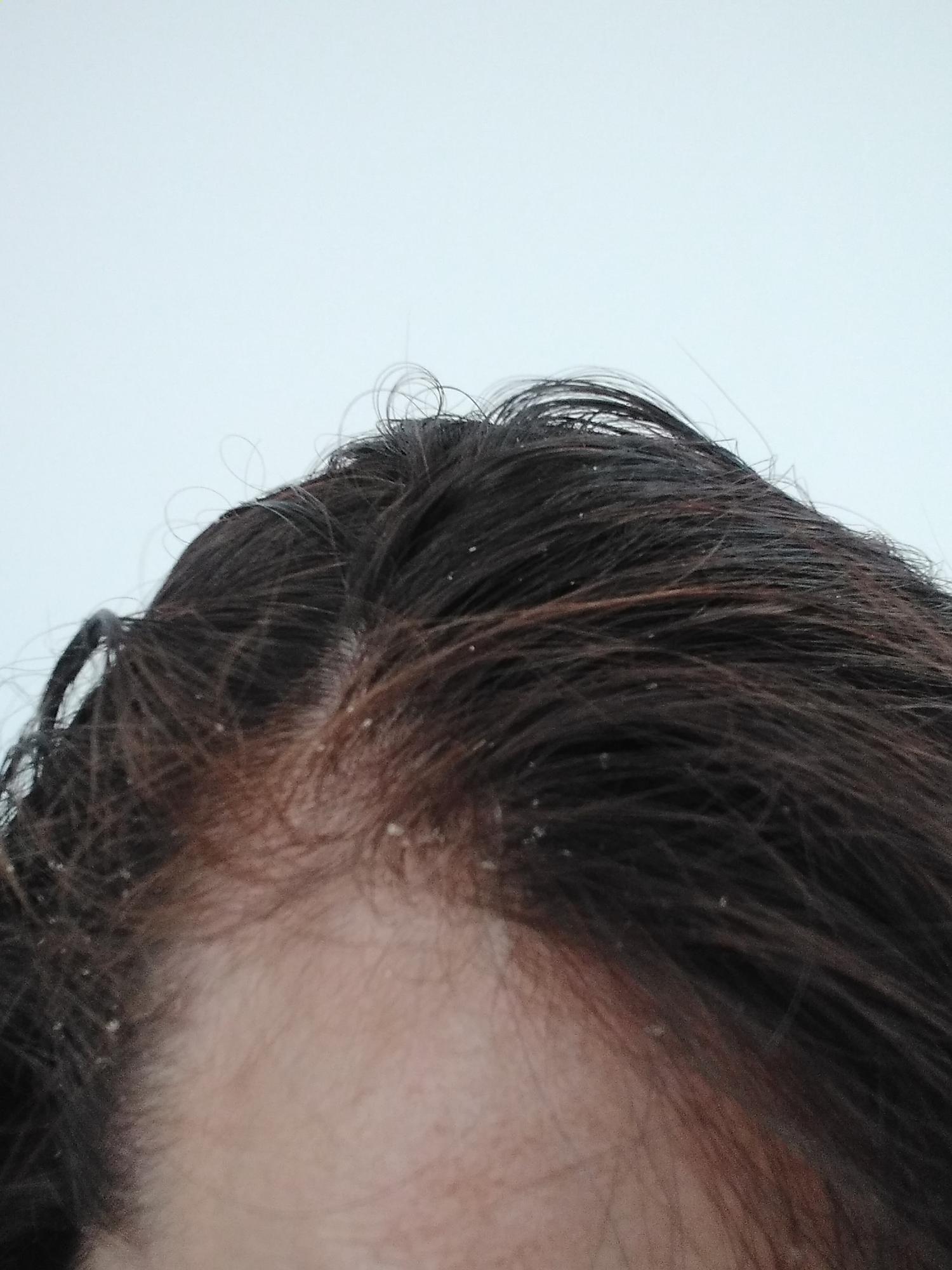 Loreal Paris Hydra Saç Kremi Kaşıntı Ve Kepek Yaptı! - Şikayetvar