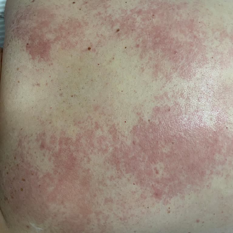 Veet Veet Tüy Dökücü Yanık - Şikayetvar