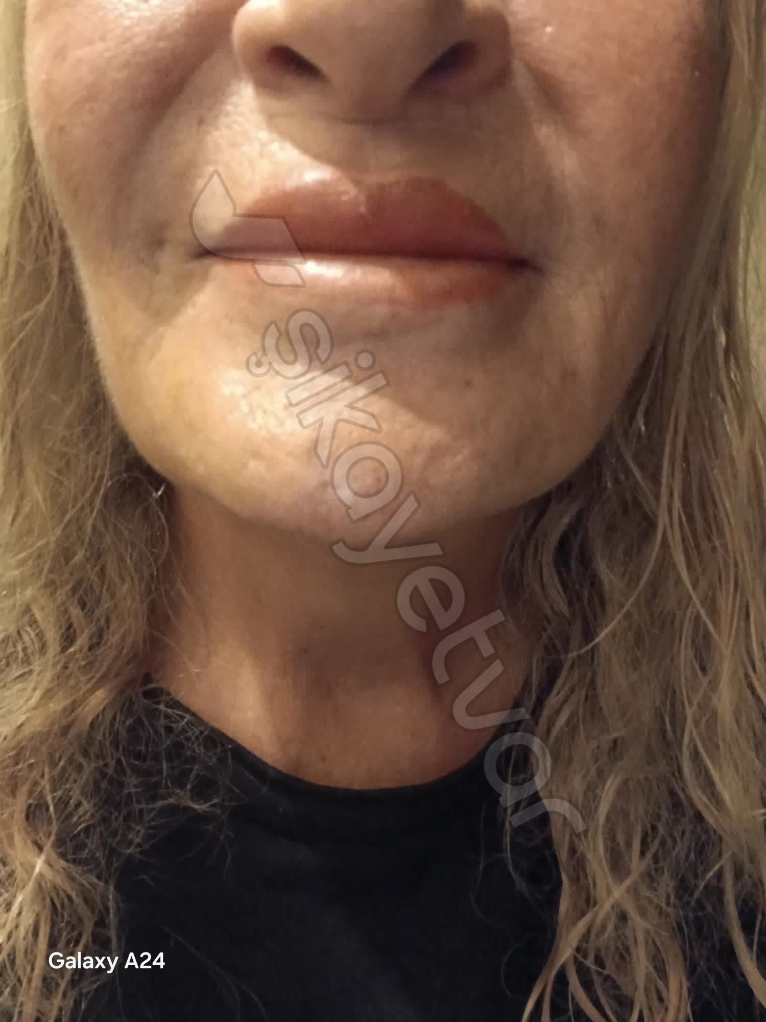 Refika Güzellik | Florya Refika Güzellik Merkezi Florya Dudak ...