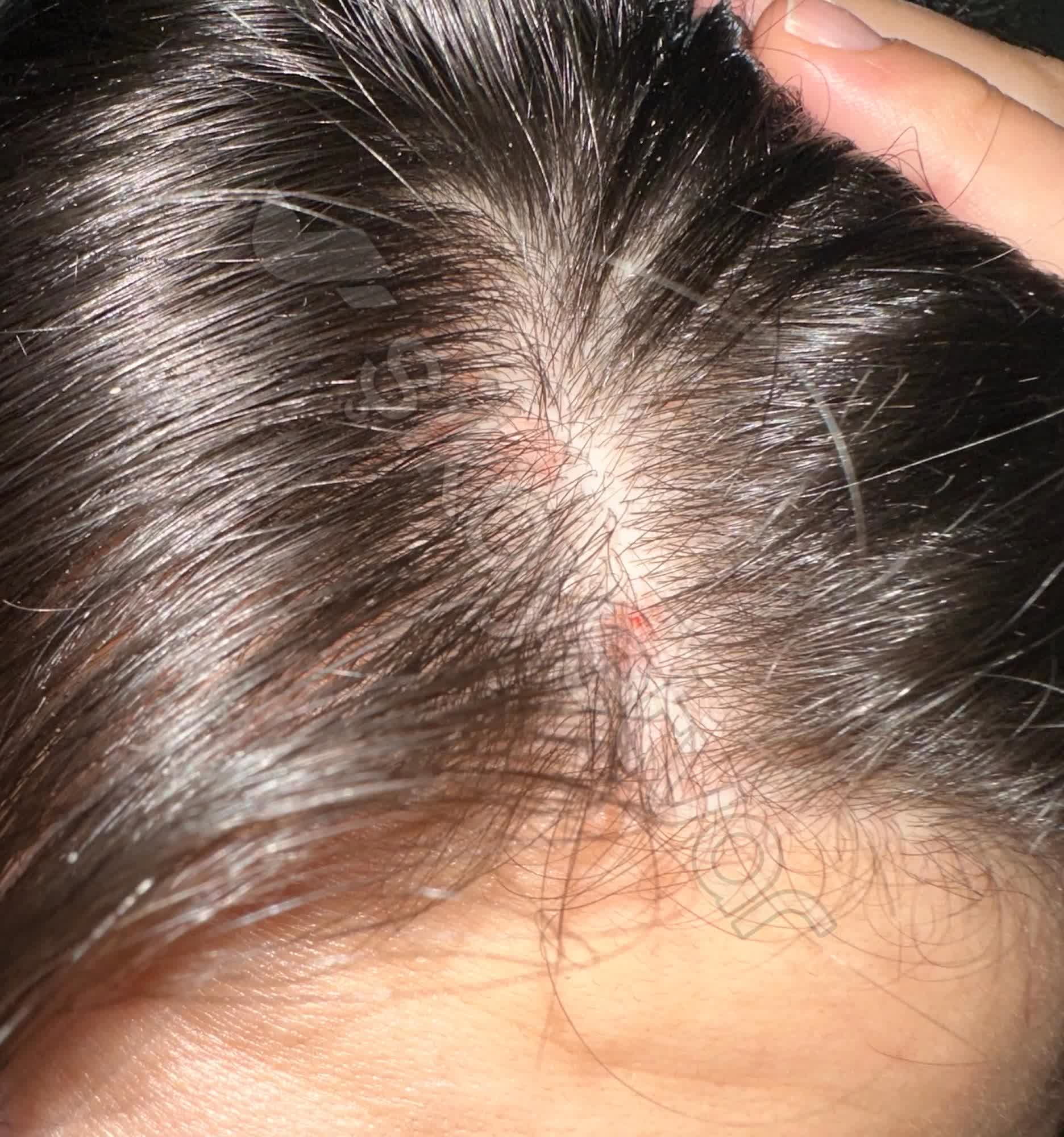 Yves Rocher Ürünleri Saç Dökülmesini Artırıyor Ve Yara Yapıyor - Şikayetvar