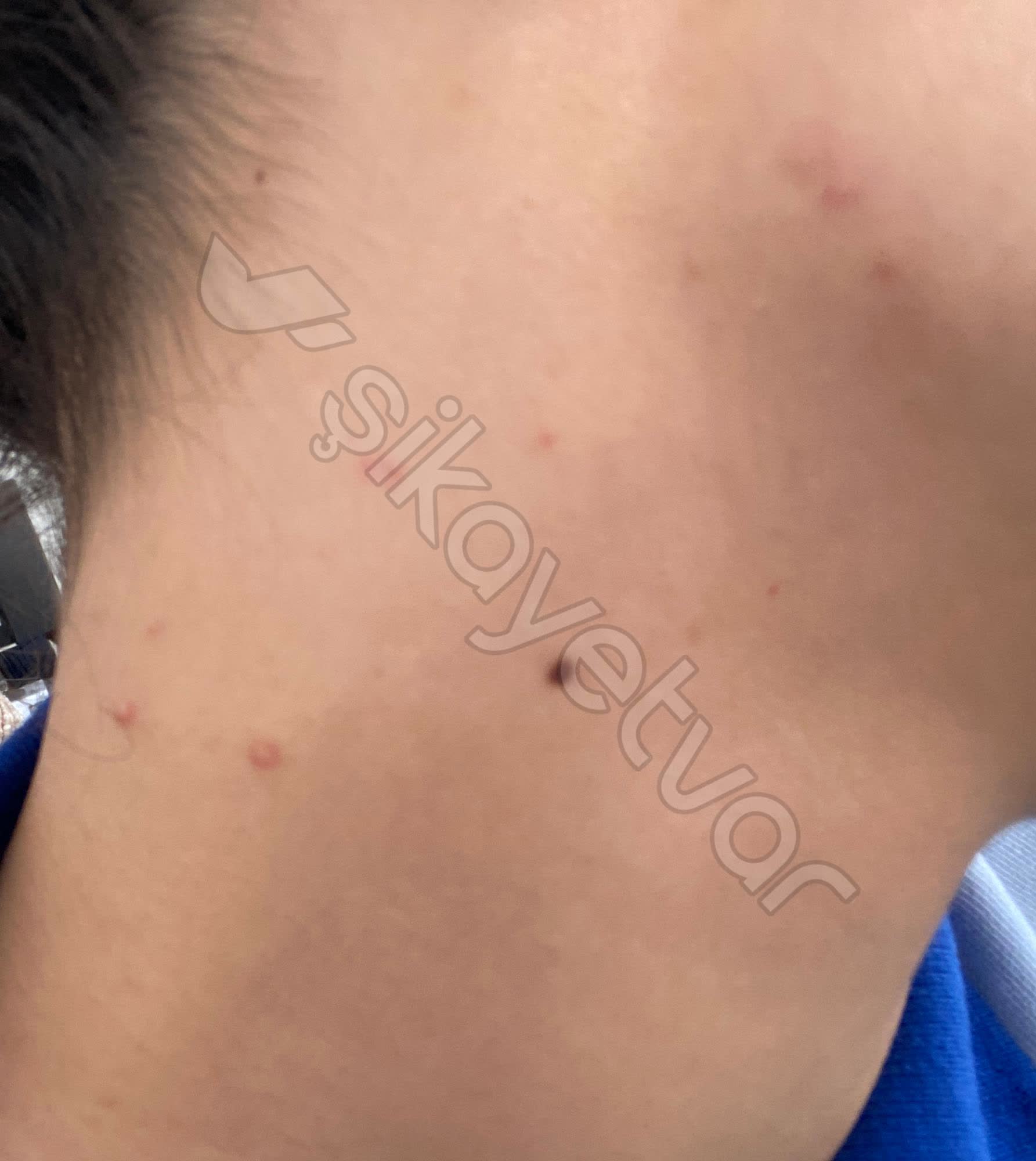 Yves Rocher Pure Algue Face Wash Caused Painful Breakouts and Redness ...