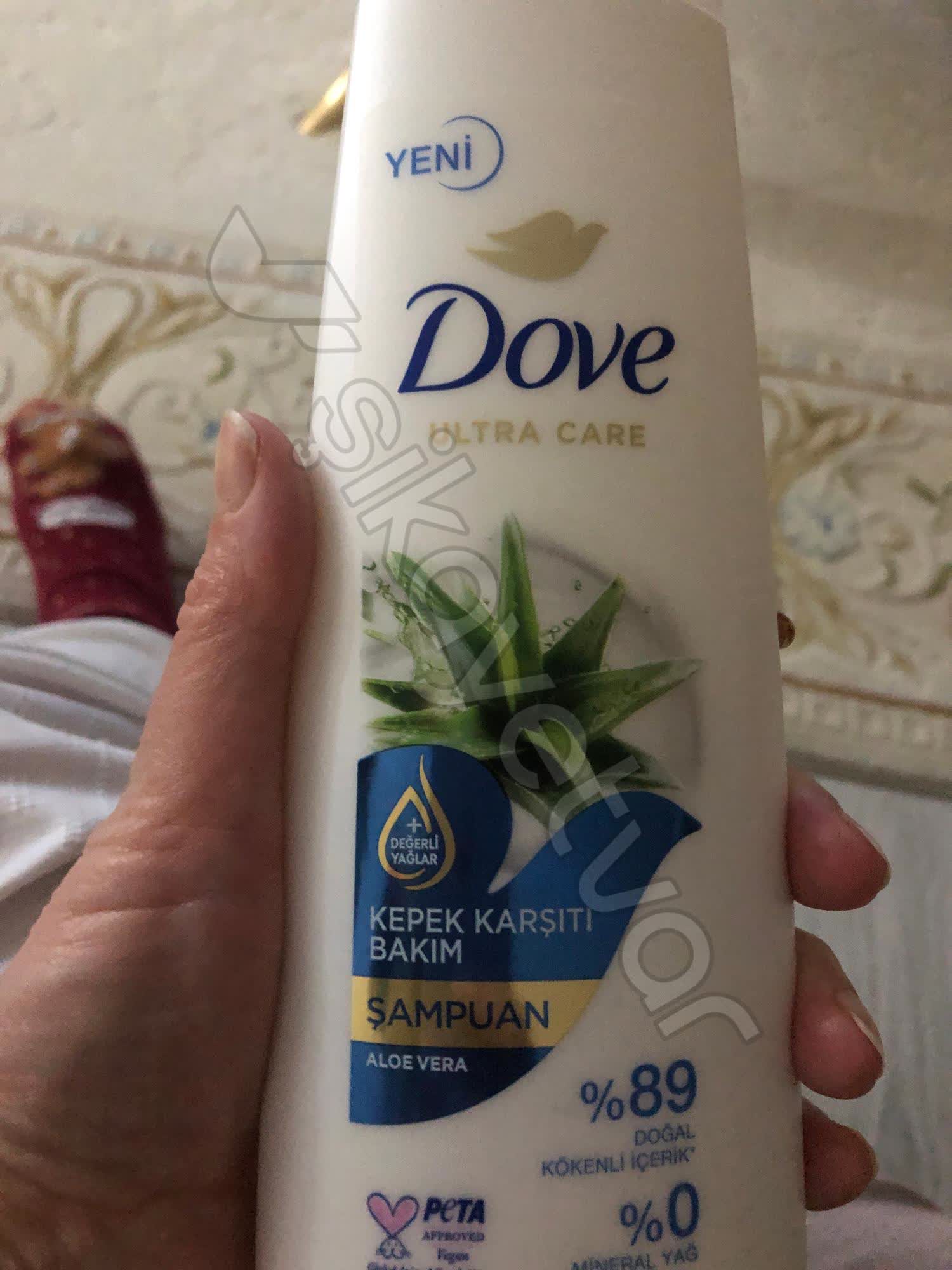 Severe Reaction to Dove Aloe Vera Anti-Dandruff Shampoo – Skin Burn and ...