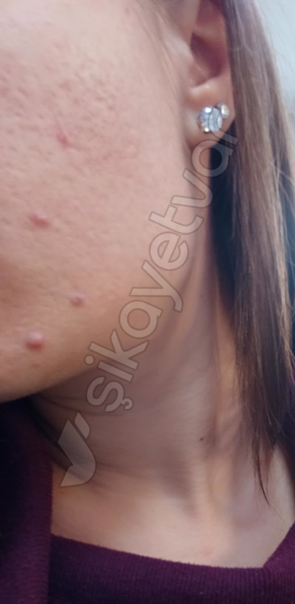 Severe Acne and Scarring from Bioderma Photoderm Spot 50 SPF - Xolvie