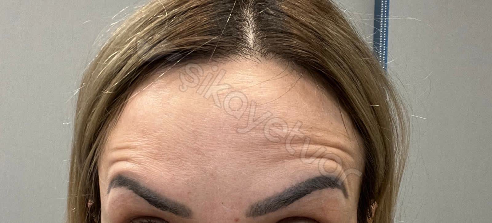 Estpoint | Estelift Estpoint Kliniğinde Başarısız Botox Deneyimi Ve ...