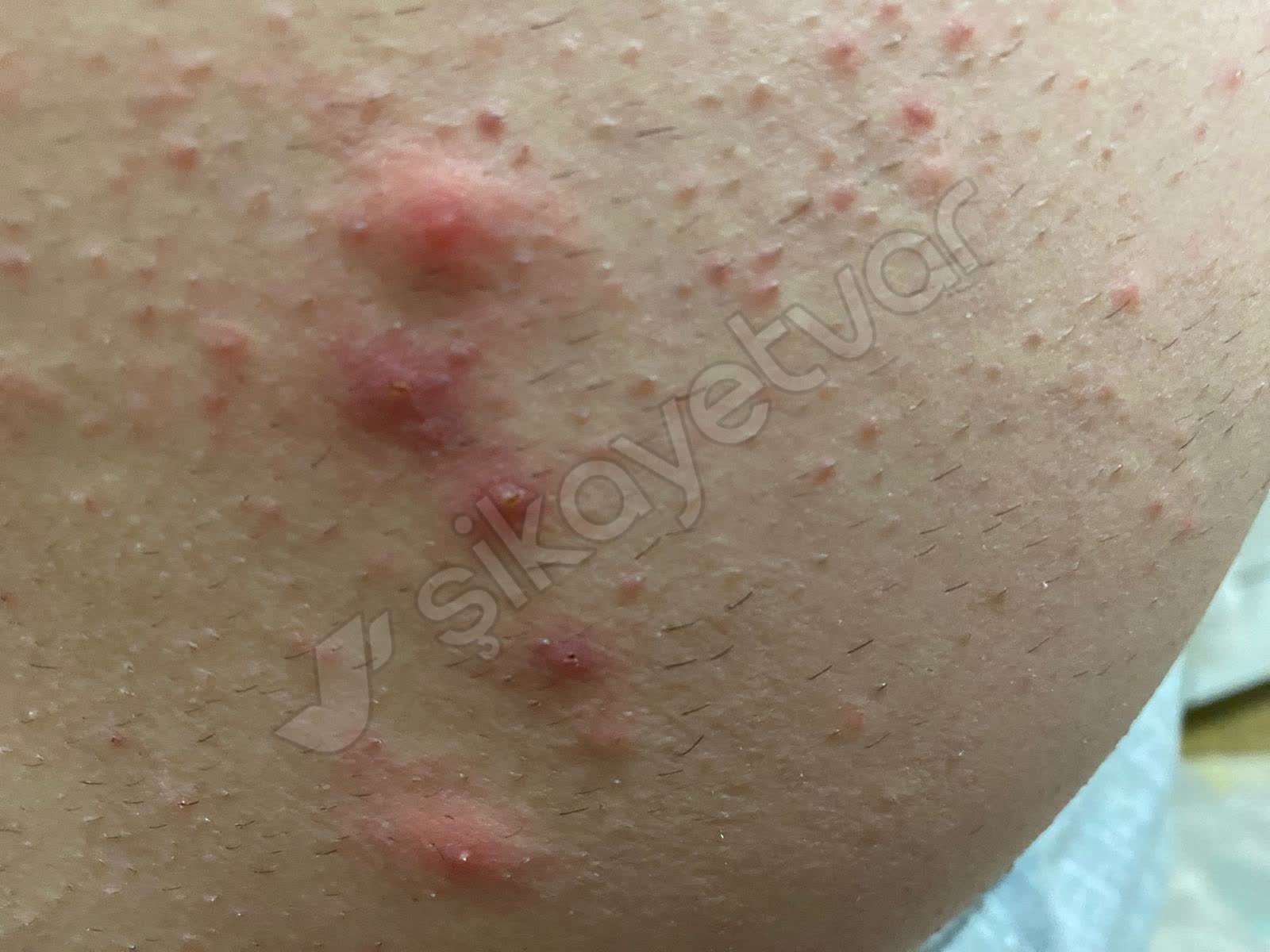 Veet Hair Removal Cream Caused Severe Skin Reactions and Rashes - Xolvie