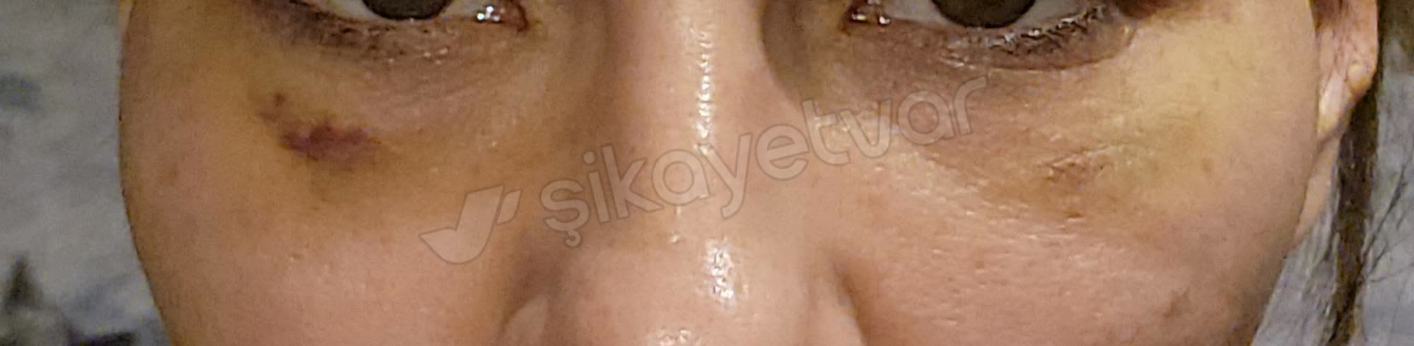 Grandmedical Hospital Göz Altı Mezoterapi Sonrası Beklenmedik Şişlik Ve ...