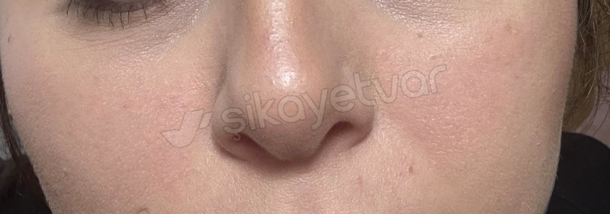 Producto Kiko Milano causa irritación en la piel - Xolvie