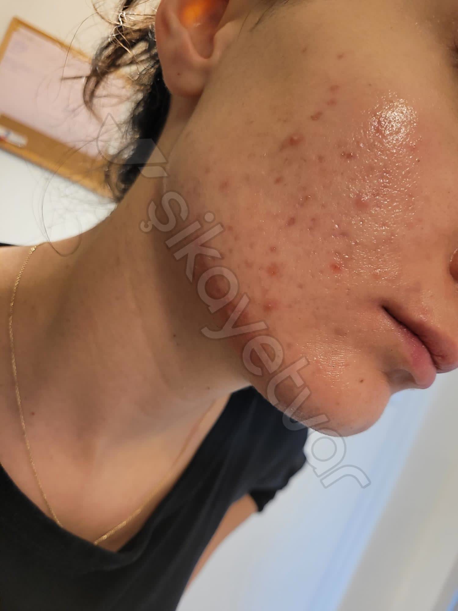 Genveon Vitakobal B12 Kullanımı Sonrası Cilt Problemleri Ve Mağduriyet - Şikayetvar