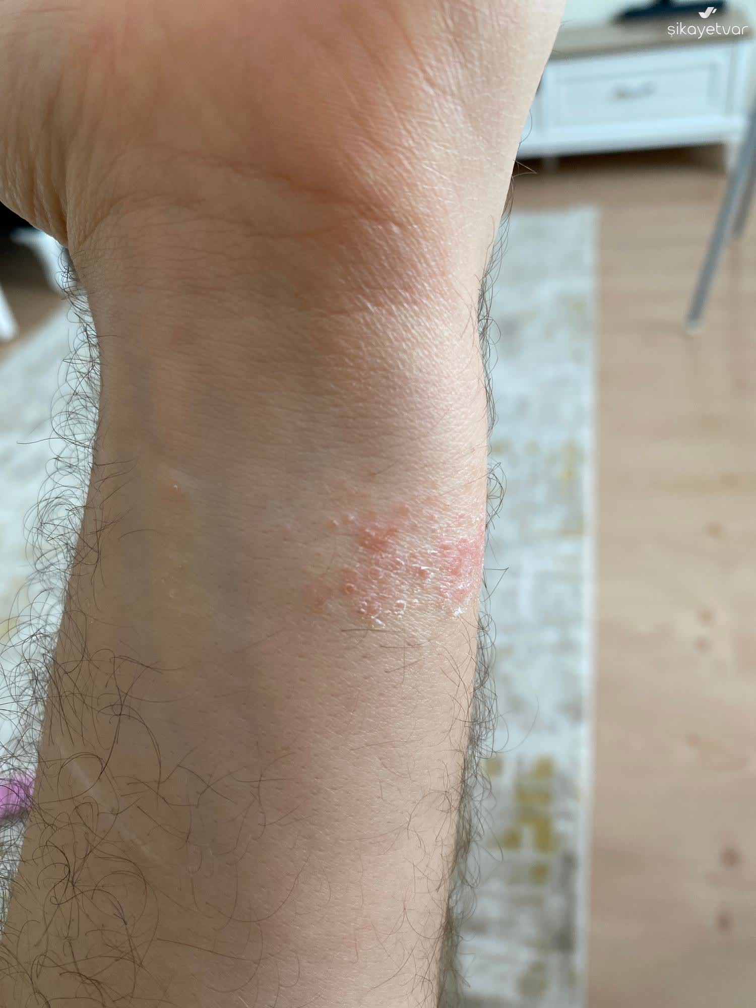 Xiaomi Watch 5 Lite: Alerji Ve Rahatsızlık Sorunu - Şikayetvar