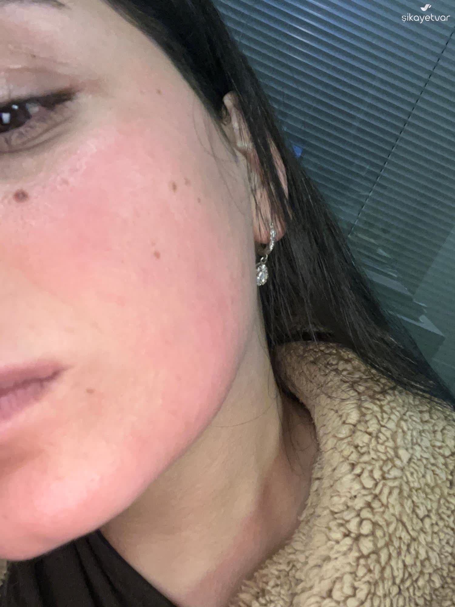 Estee Lauder Cream Caused Severe Allergic Reaction on My Face - Xolvie