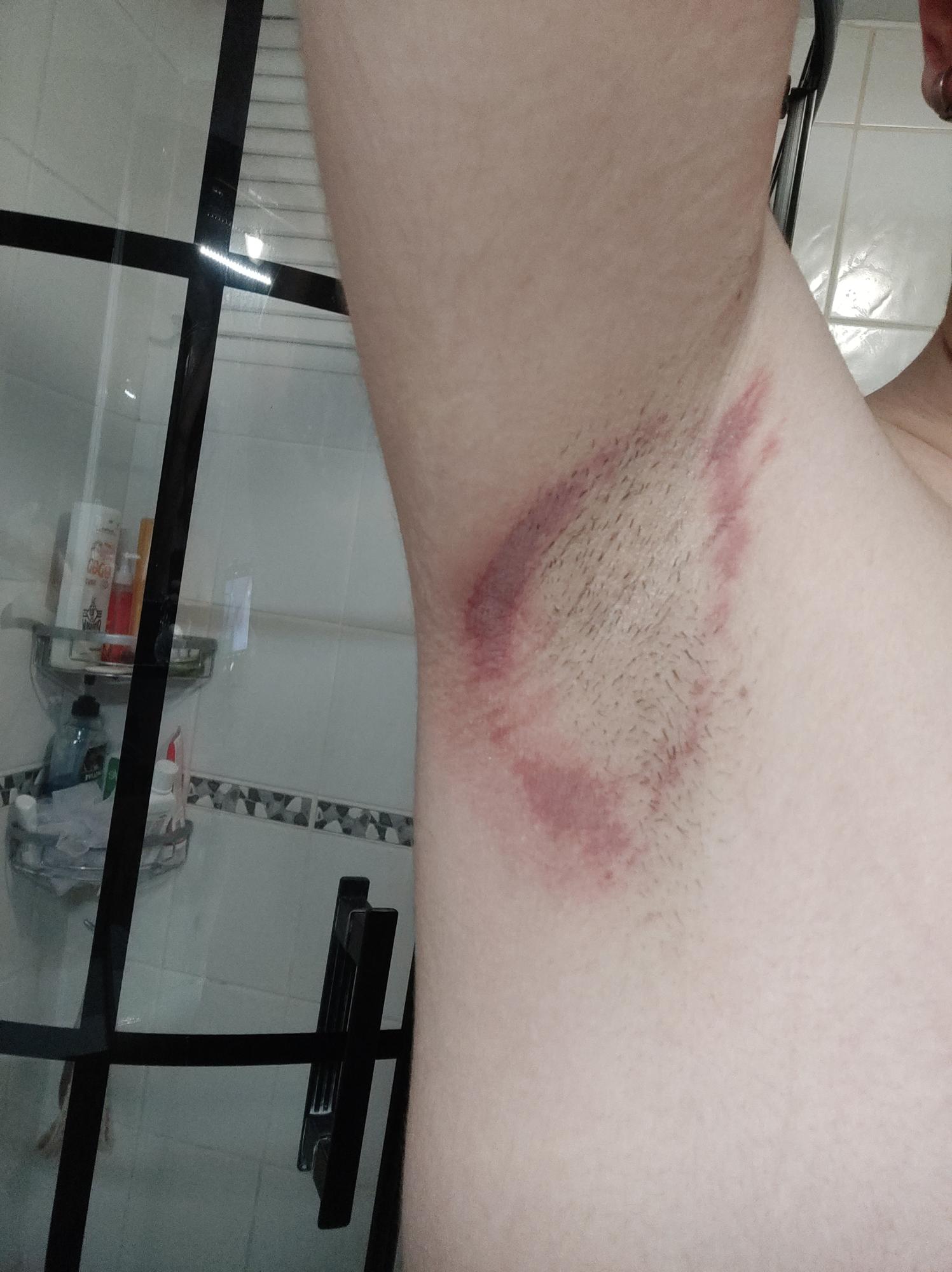 Old Spice Whitewater Stick Burned My Underarms—Now I’m Getting Treated ...