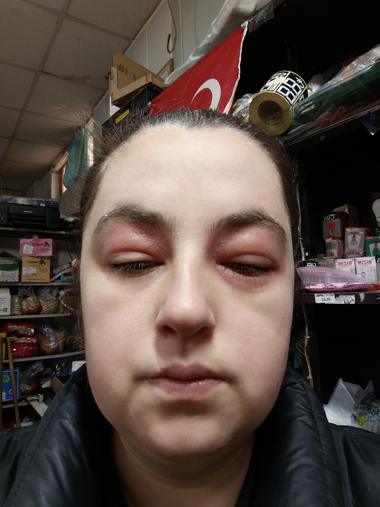 I Experienced Swelling and Irritation from Ducray Dexyane Med Palpebral ...