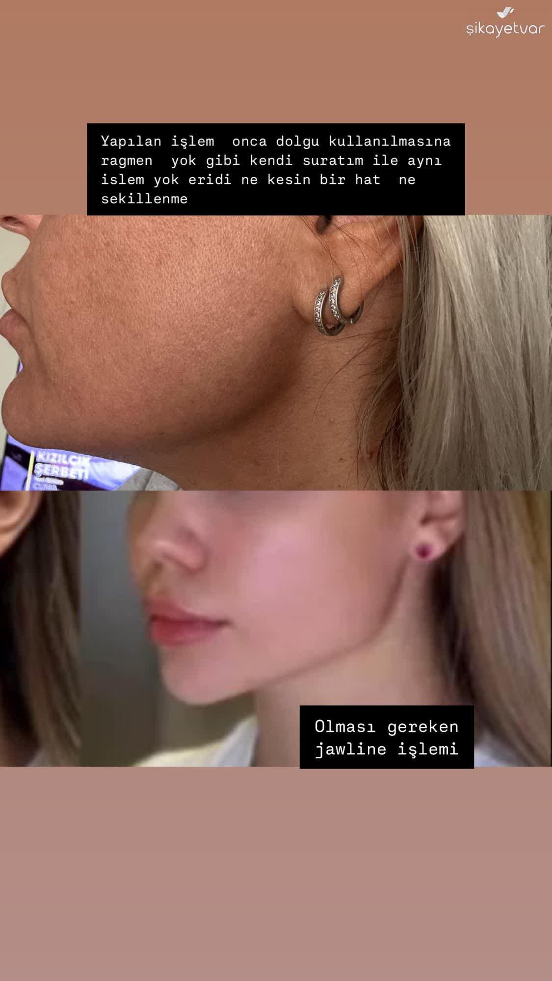 Alis Estetik | Bakırköy Estetik İşlem Sonrası Hayal Kırıklığı Ve ...