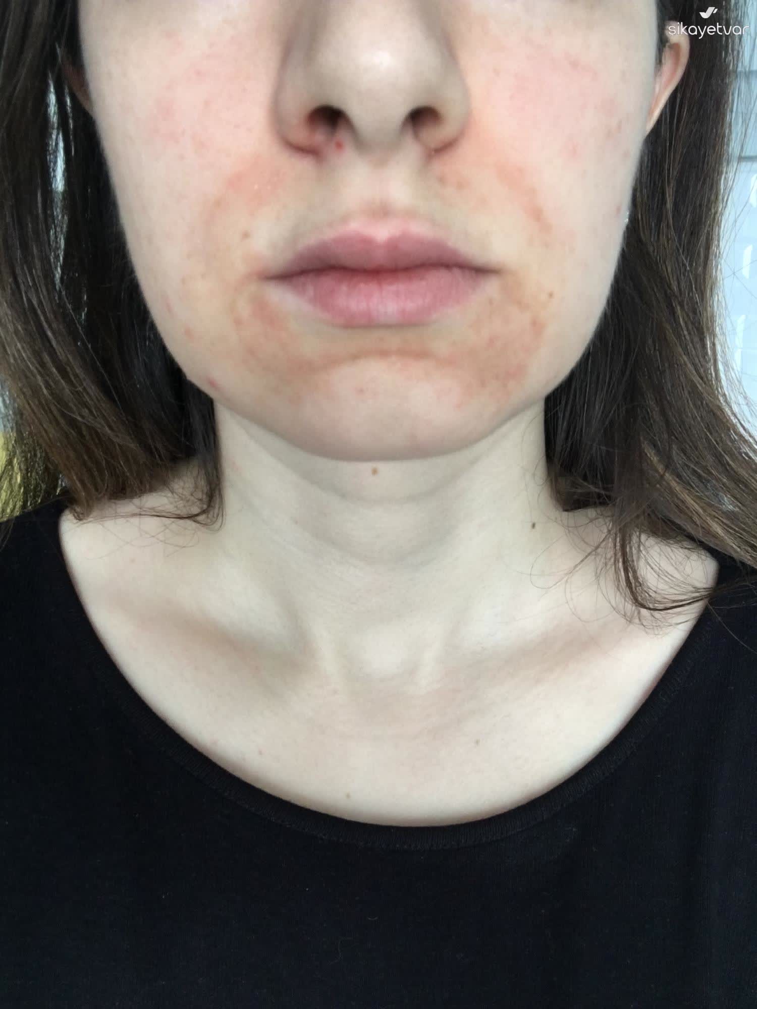 Cream Co Mavi Nemlendirici Cilt Sorunlarına Yol Açtı - Şikayetvar