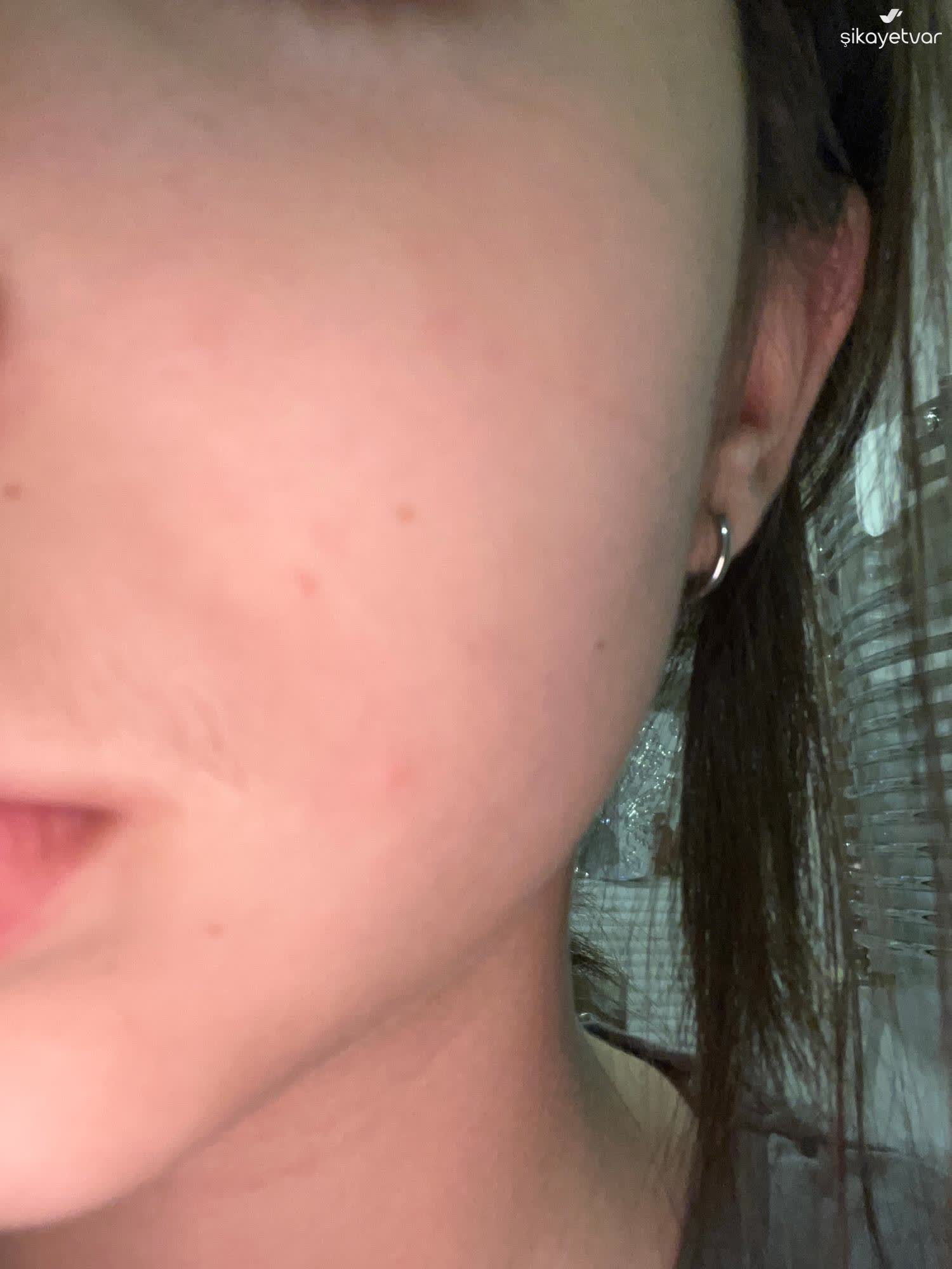 L'Oréal Paris Face Sunscreen Caused Redness and Bumps on My Sensitive ...