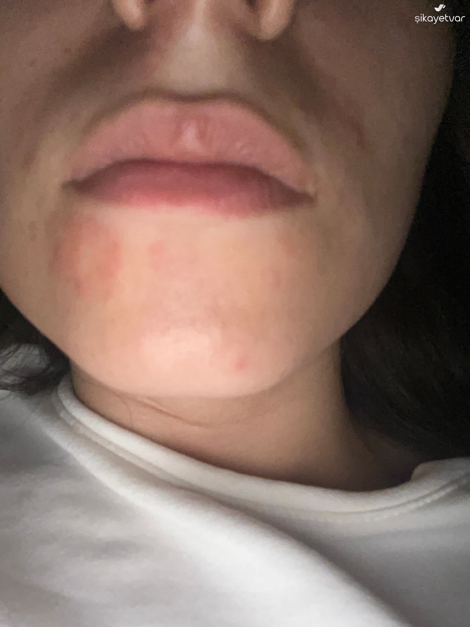 Yves Rocher Shampoo Caused Severe Allergic Reaction and Skin Swelling ...