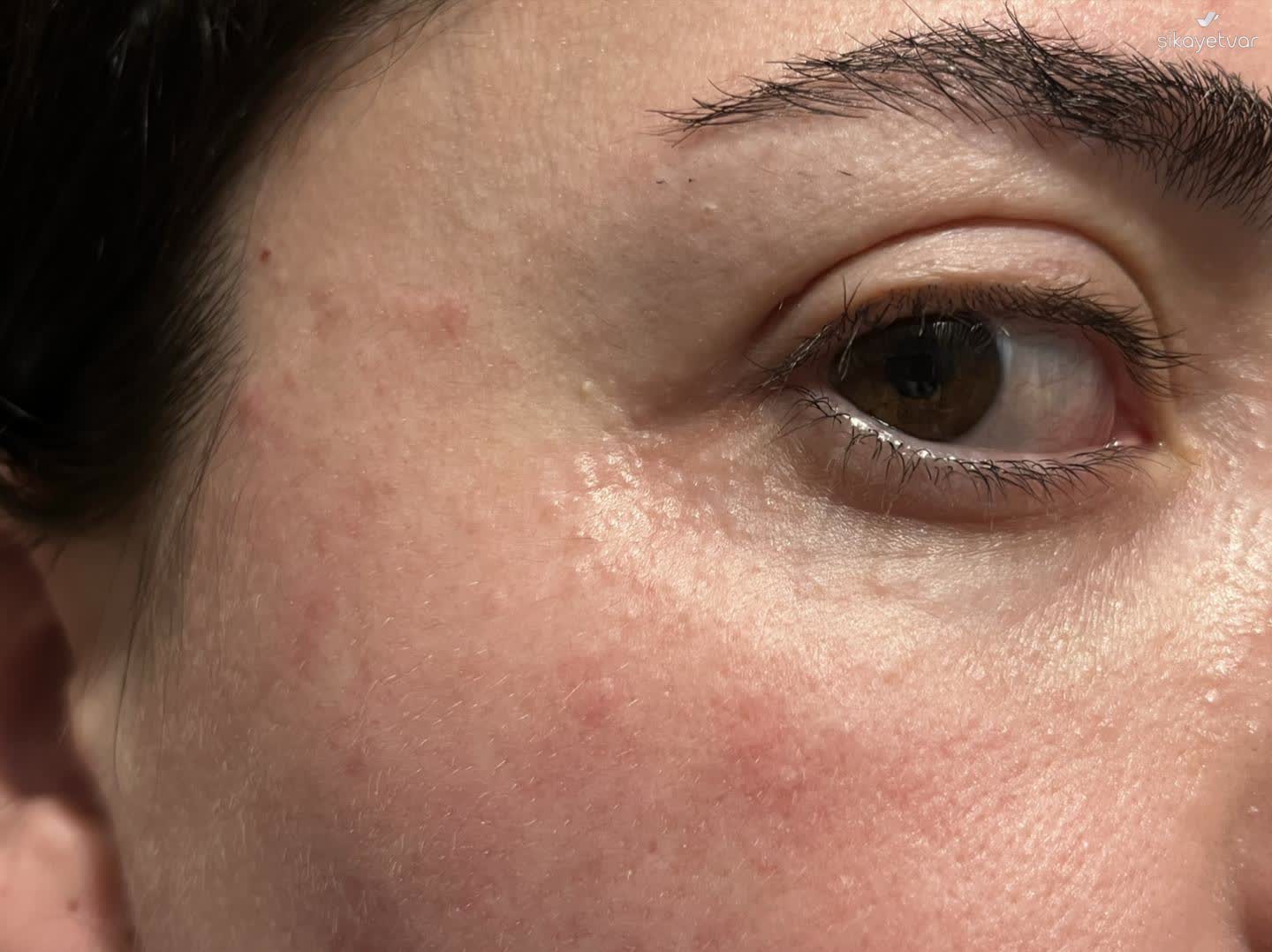 Clinique Clinique All About Eyes Cream Gave Me a Severe Allergic ...