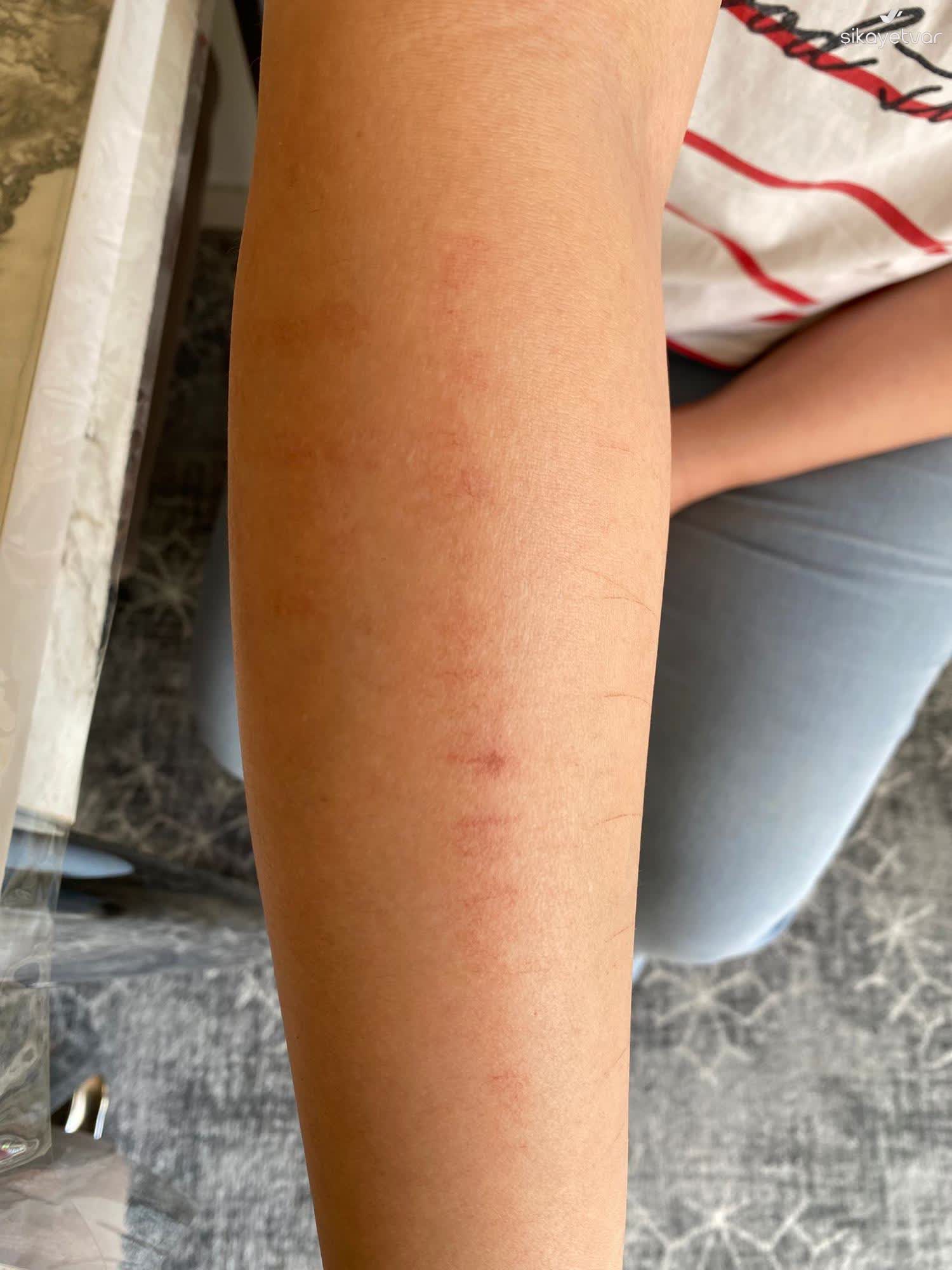 Queenez Sağlık ve Güzellik Merkezi Lazer Epilasyon Sonrası Kolumda Yanık Oluştu, İlgisiz ...