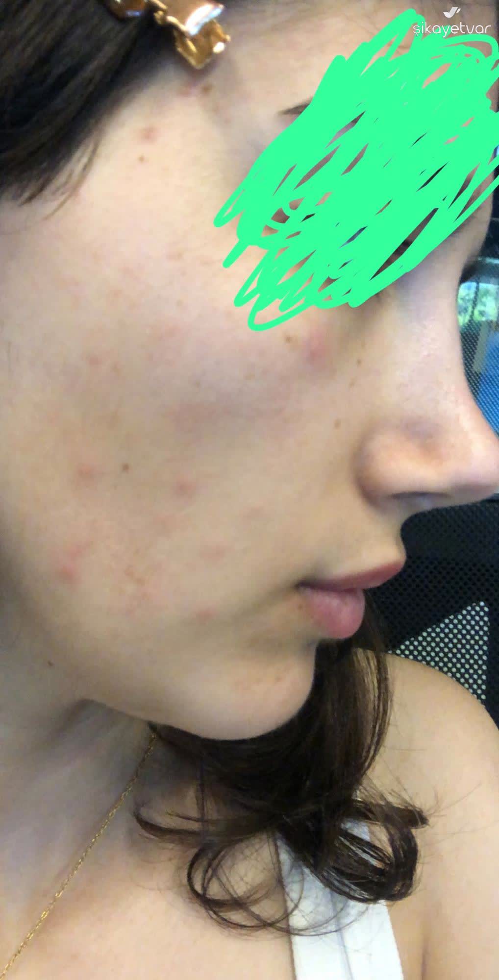 Flormar Fondг Ten Cildimde Sivilce Ve Yaдџlanmaya Yol Aг Tд Hayal