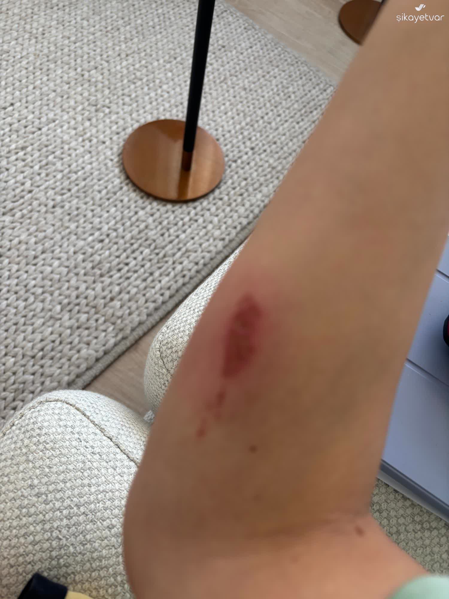 Dyson I Face Burn Injury from Loose Brush Head on My Dyson Airwrap and ...