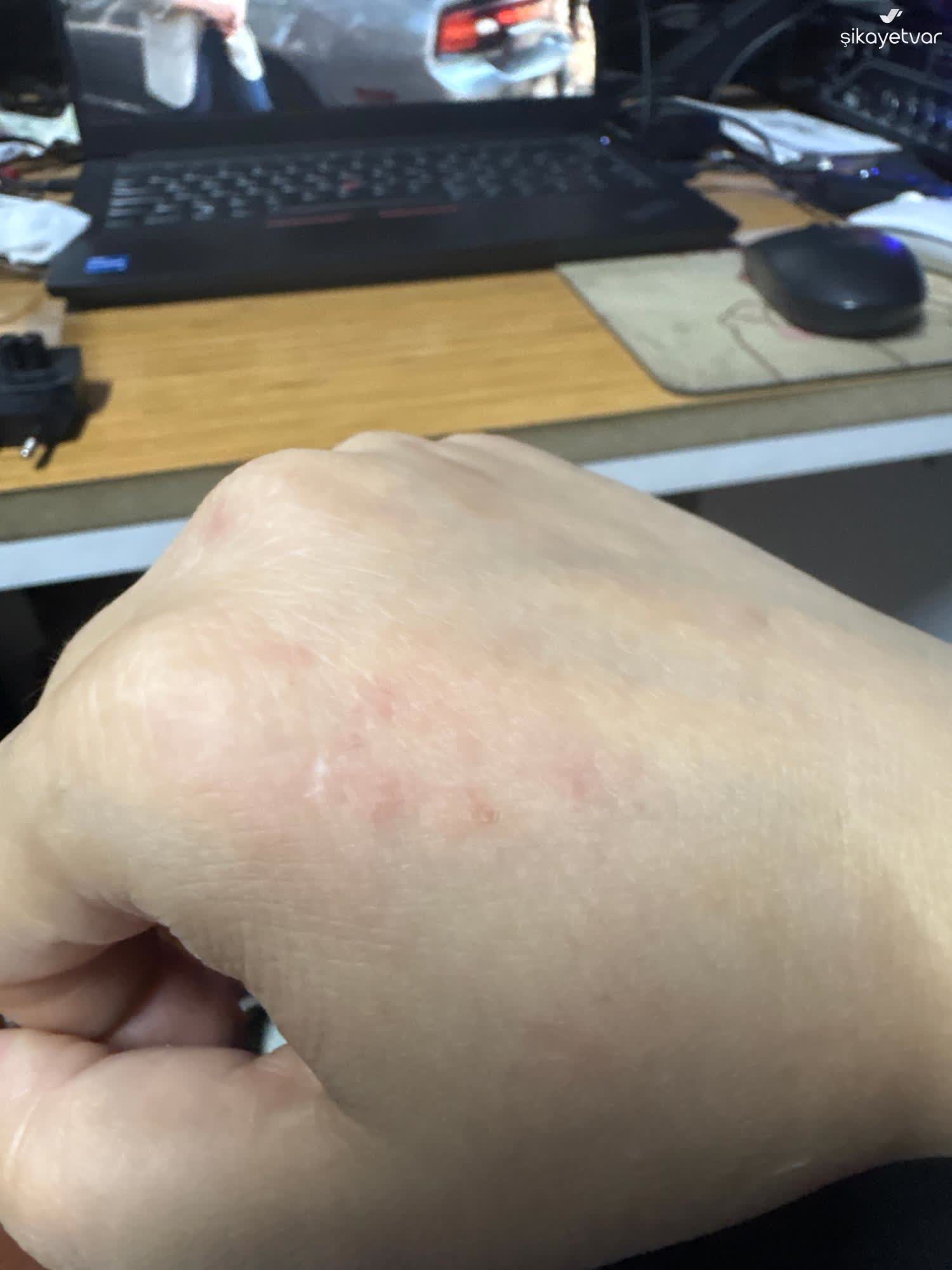 OFF I Had Skin Rash and Itching After Using Off Mosquito Repellent ...