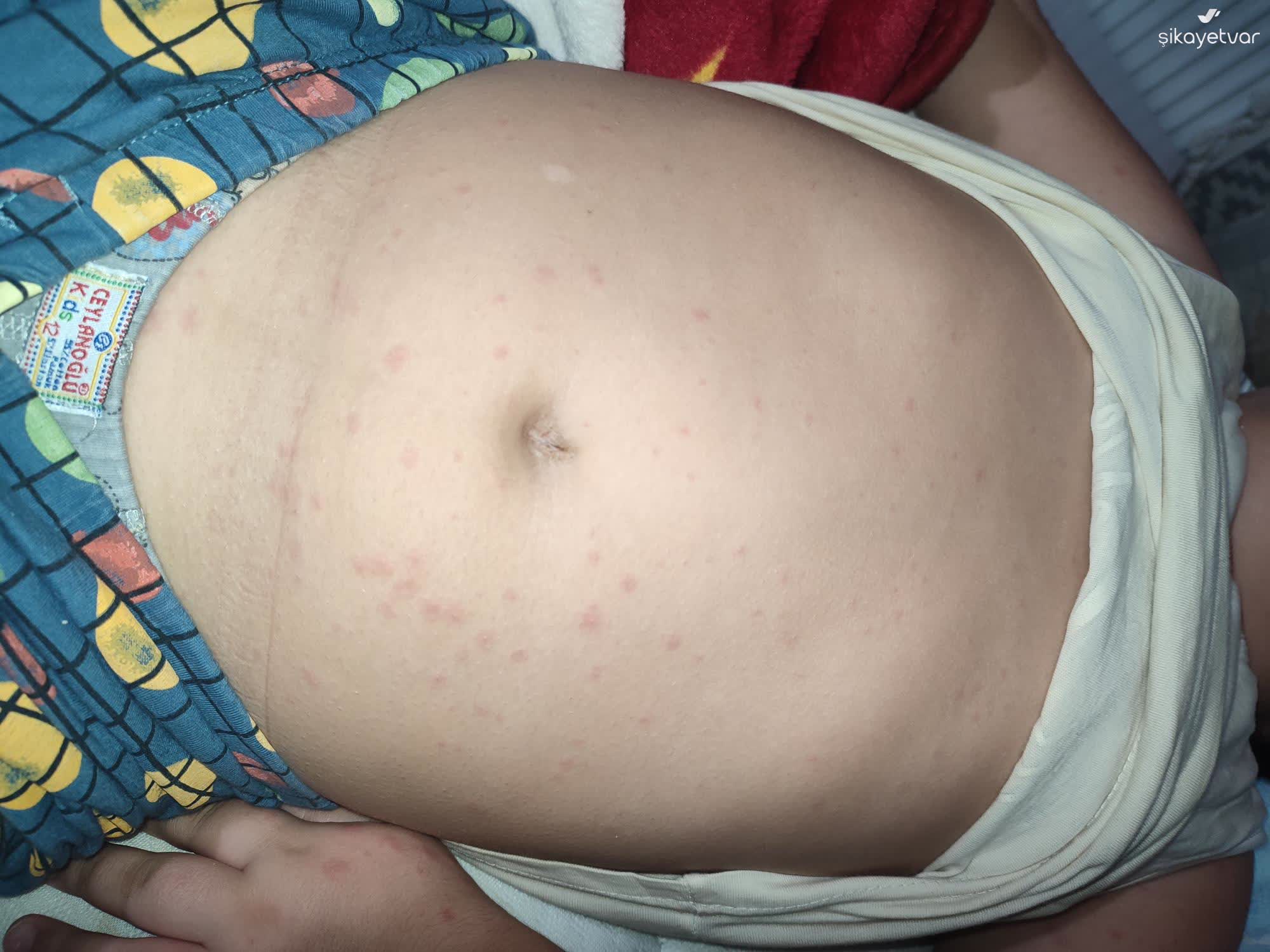 Bilim İlaç Klamoks Es 600 Antibiyotik Oğlumda Ciddi Alerjik Reaksiyona ...