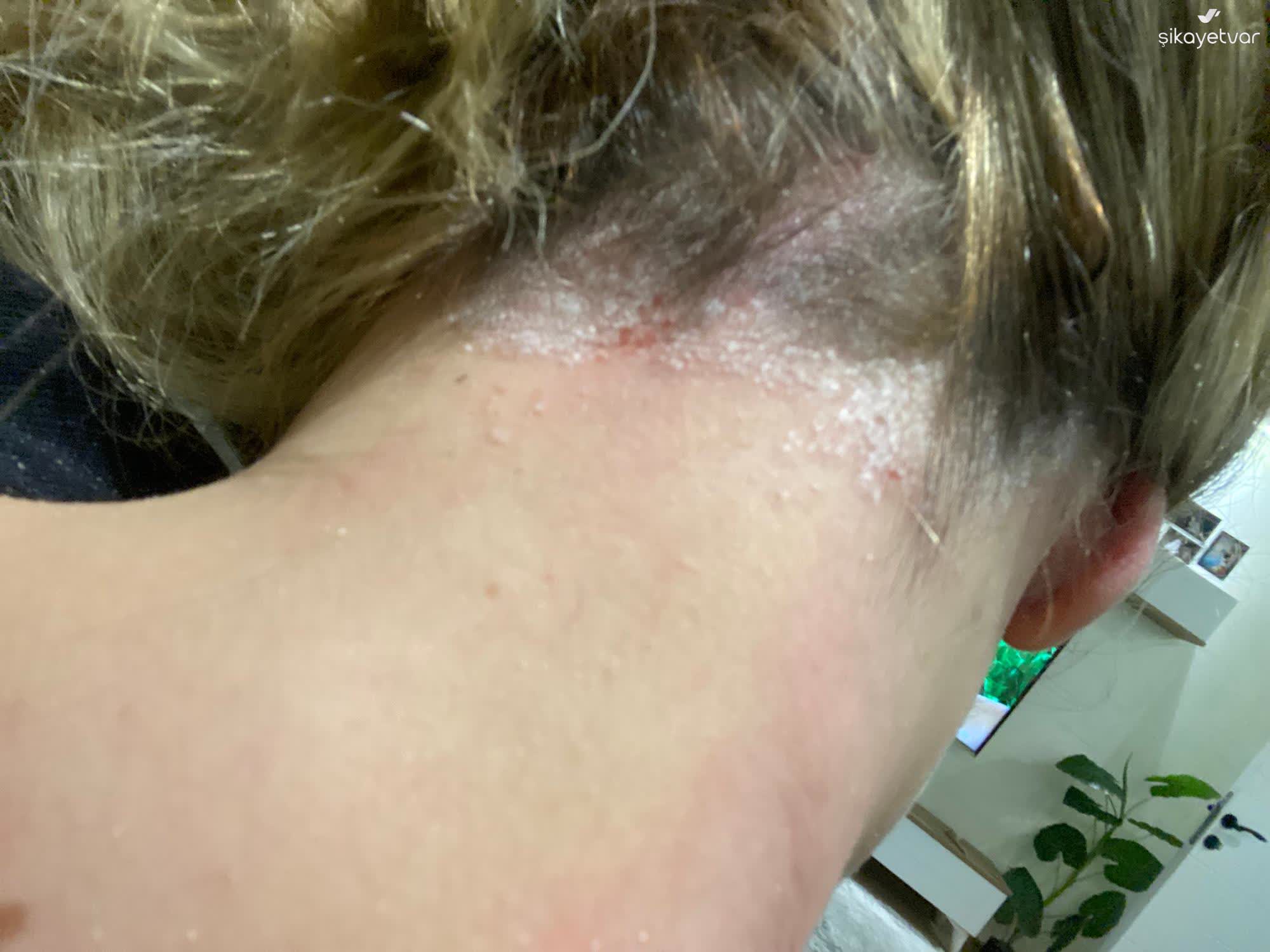 Vichy Markaya Güvenerek Aldığım Şampuan Saç Derimde Sorunları Artırdı ...