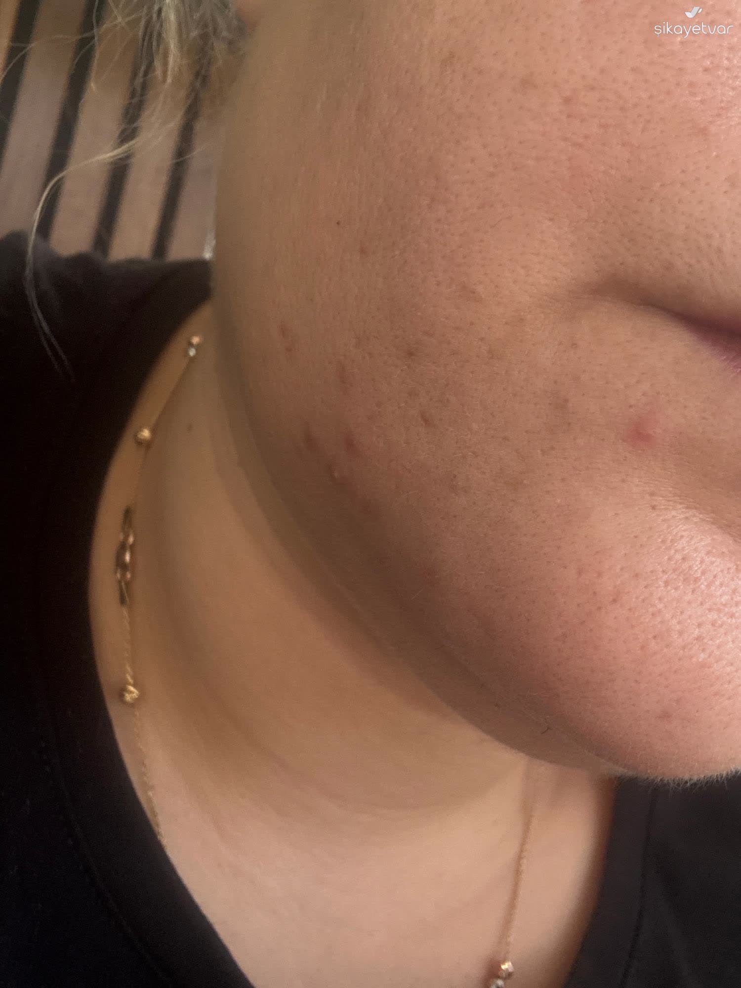 La Roche - Posay Effaclar Ürünleri Cildimde Şiddetli İltihap Ve ...