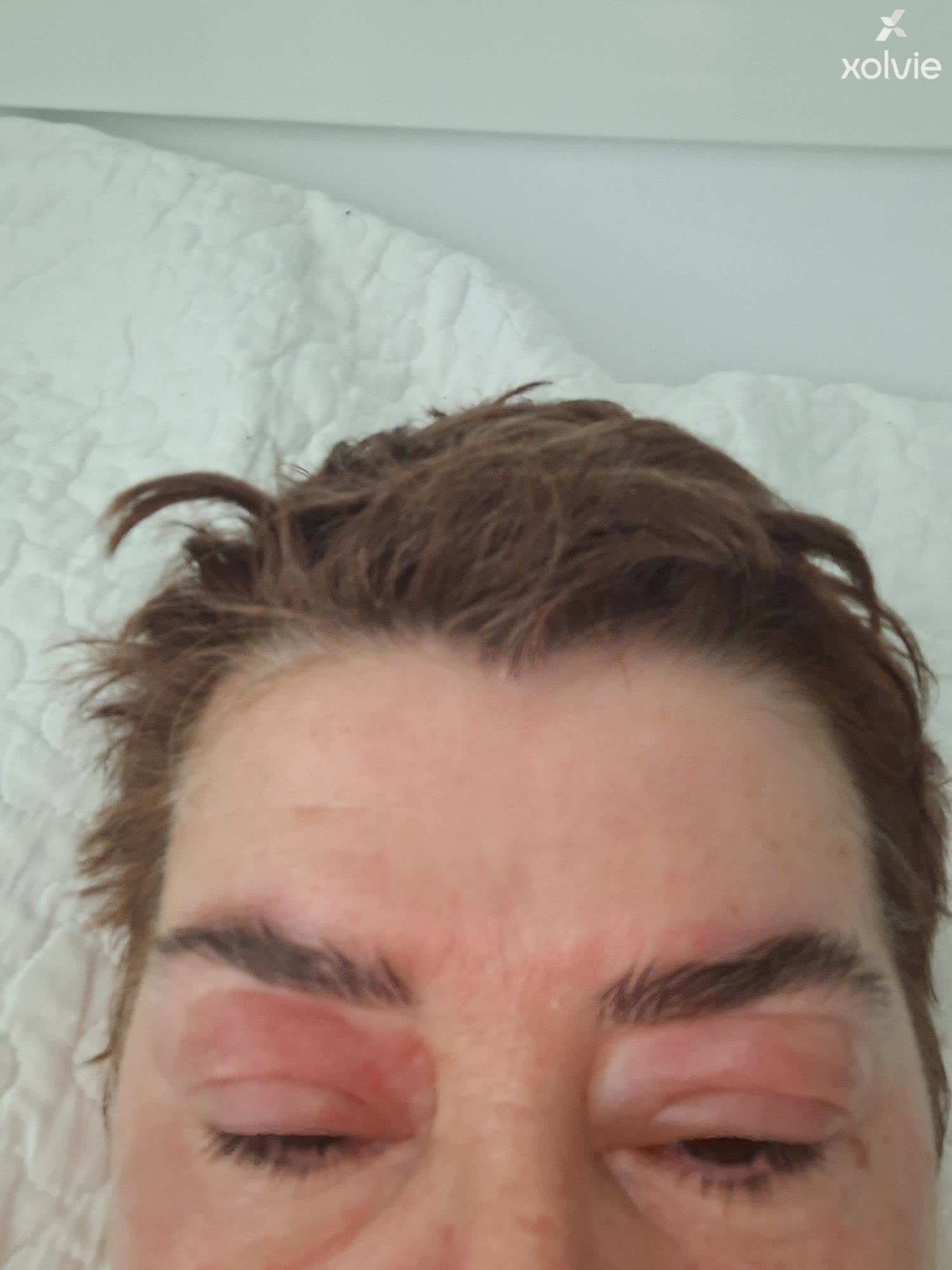 Ducray Dexyane Med Palpebral Caused Severe Eyelid Swelling After First ...