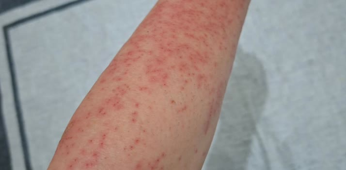 Gratis Remove Tüy Dökücü Jelinde Şiddetli Cilt Tahrişi Ve Yanma ...